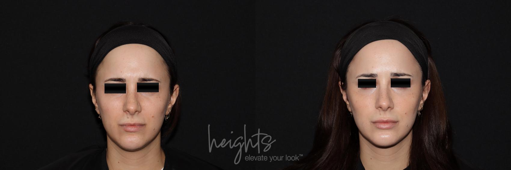 BOTOX COSMETIC® Before and After Pictures Case 105 | Vancouver (Burnaby ...