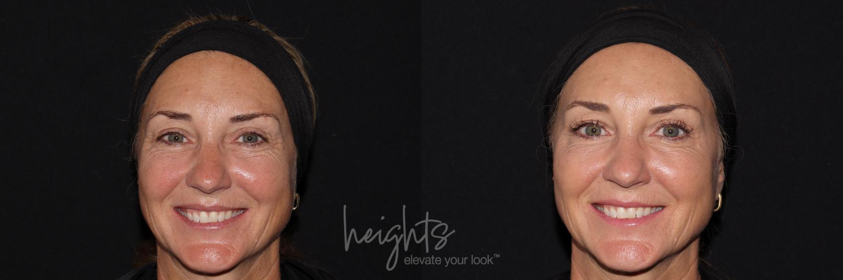 BOTOX COSMETIC® Before and After Pictures Case 141 | Burnaby ...